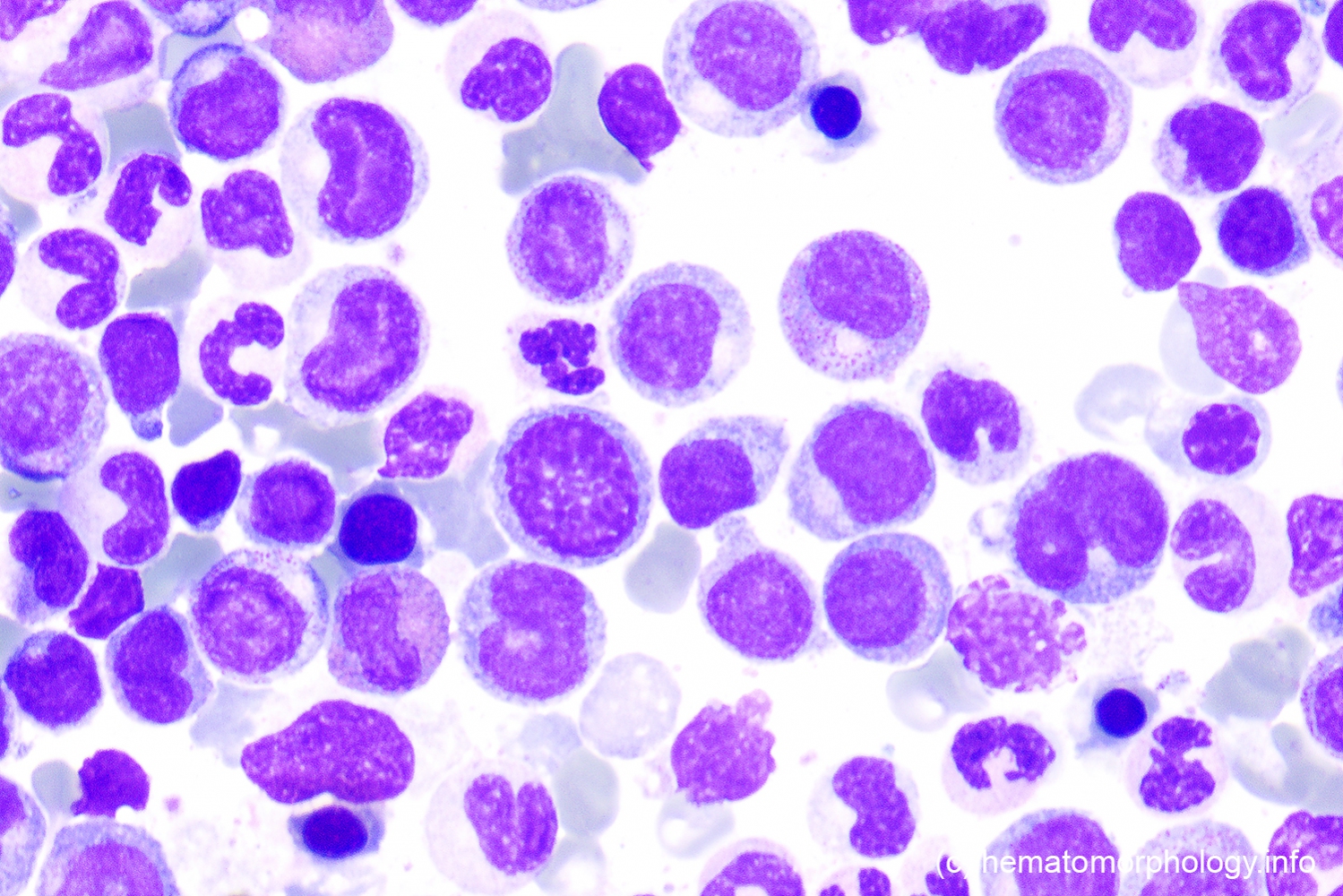 chronic-myelomonocytic-leukemia-cmml-hematomorphology-a-databank