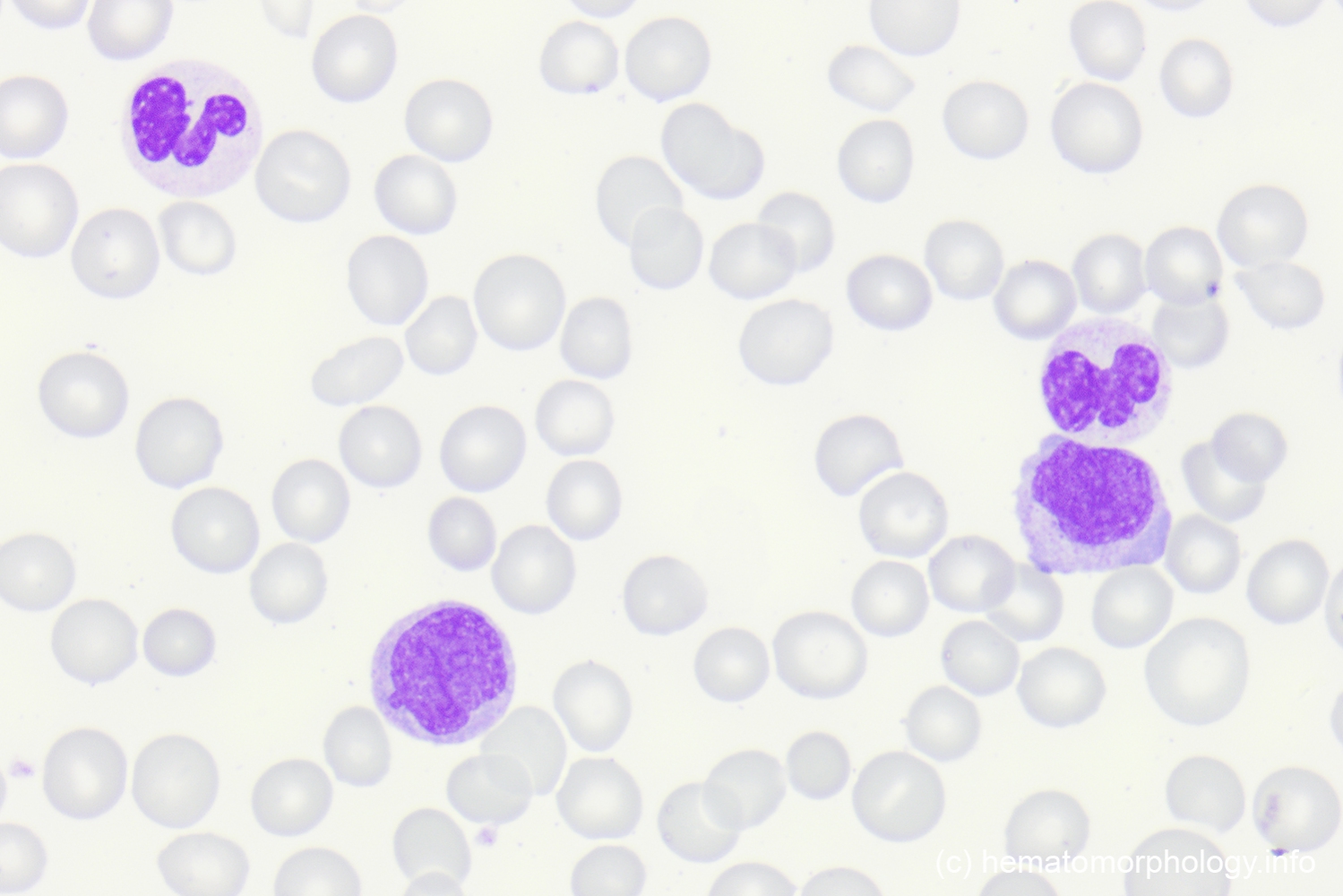 Chronic Myelomonocytic Leukemia CMML Hematomorphology A Databank Chronic Myelomonocytic Leukemia CMML Hematomorphology A Databank