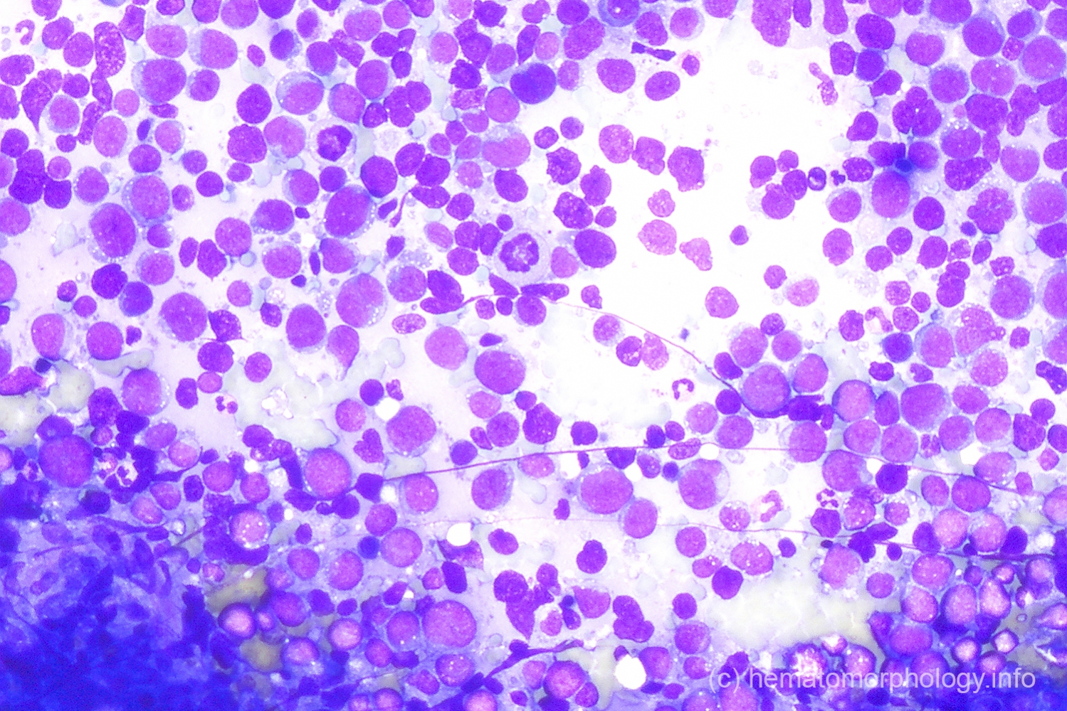 Diffuse Large B-cell Lymphoma (DLBCL) - Hematomorphology, a databank / imagebank for hematology ...