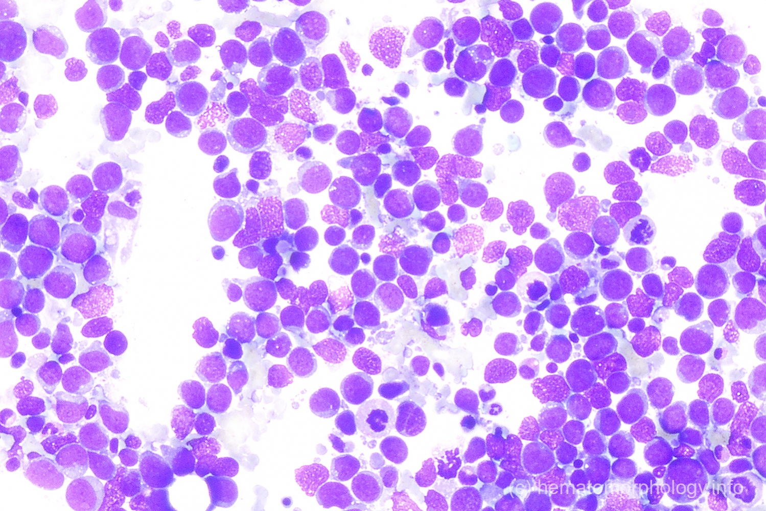 Diffuse Large B-cell Lymphoma (DLBCL) - Hematomorphology, a databank / imagebank for hematology ...