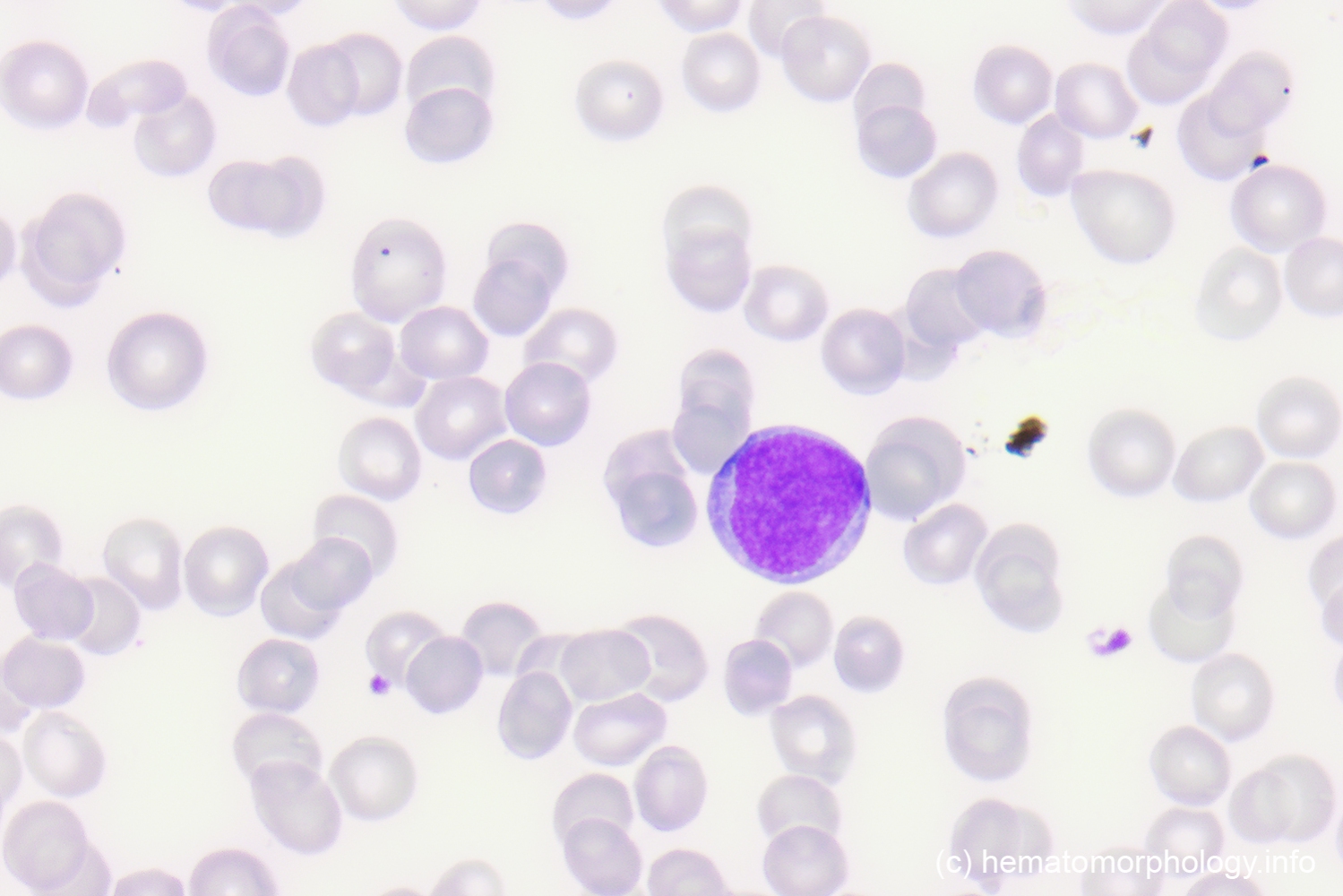 AML with minimal differentiation - Hematomorphology, a databank ...