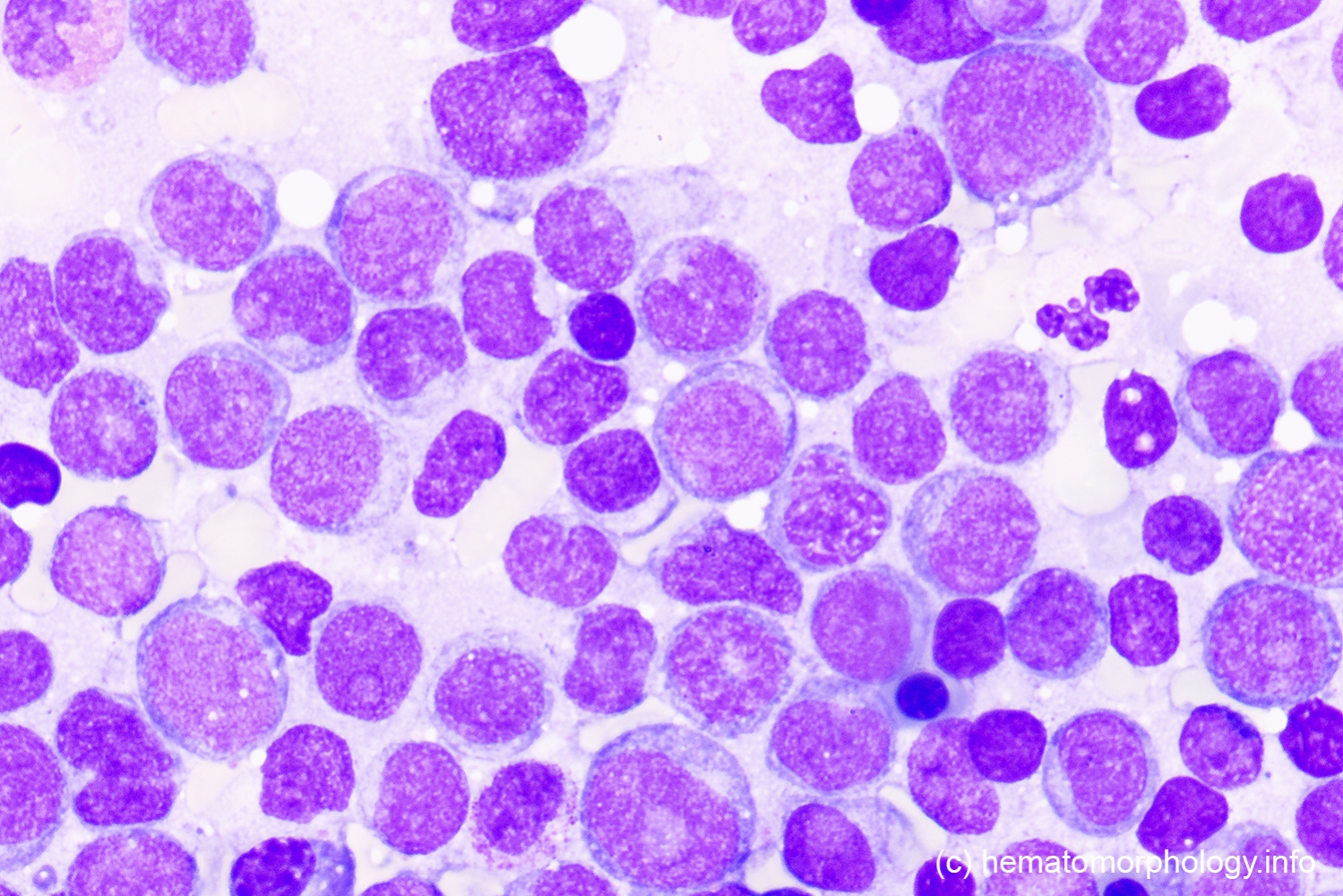 AML myelomonocytic - Hematomorphology, a databank / imagebank for ...