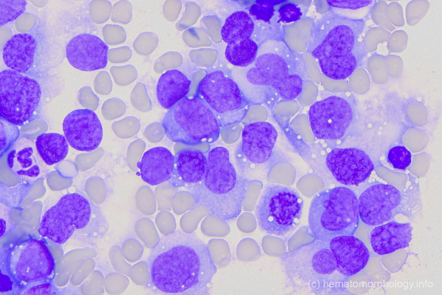 AML erythroid leukemia - Hematomorphology, a databank / imagebank for ...