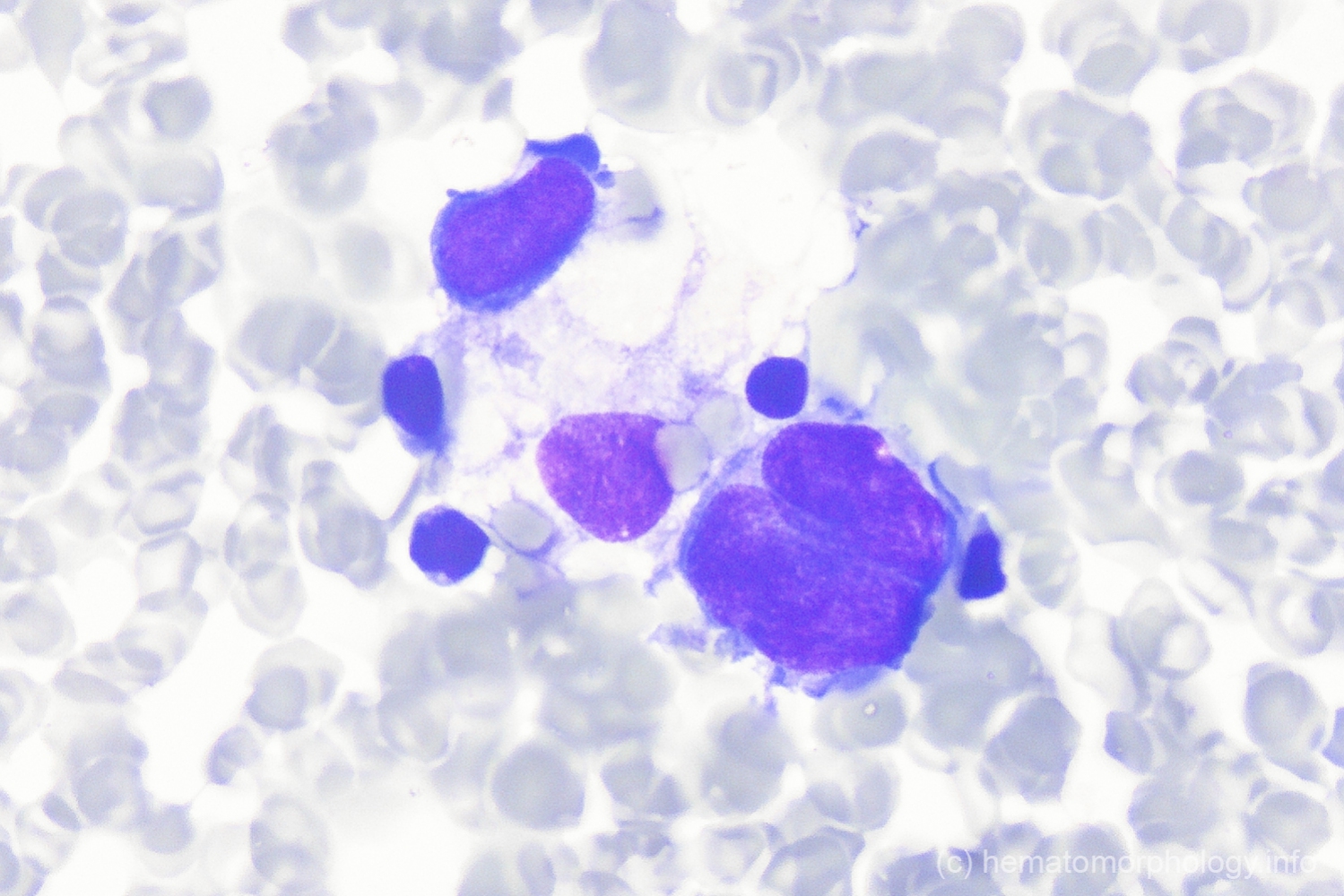 AML megakaryoblastic leukemia - Hematomorphology, a databank ...