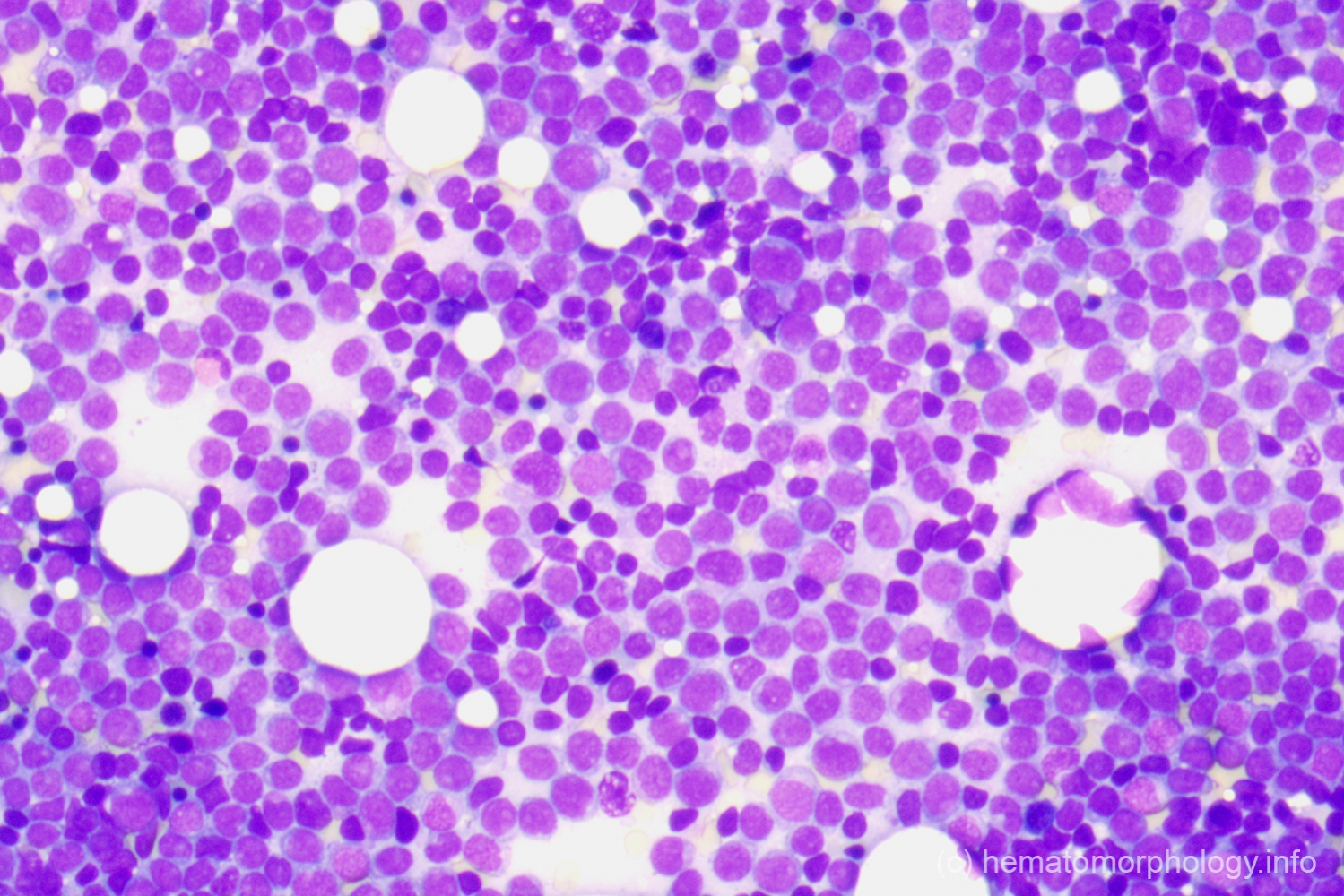 AML without maturation - Hematomorphology, a databank / imagebank for ...