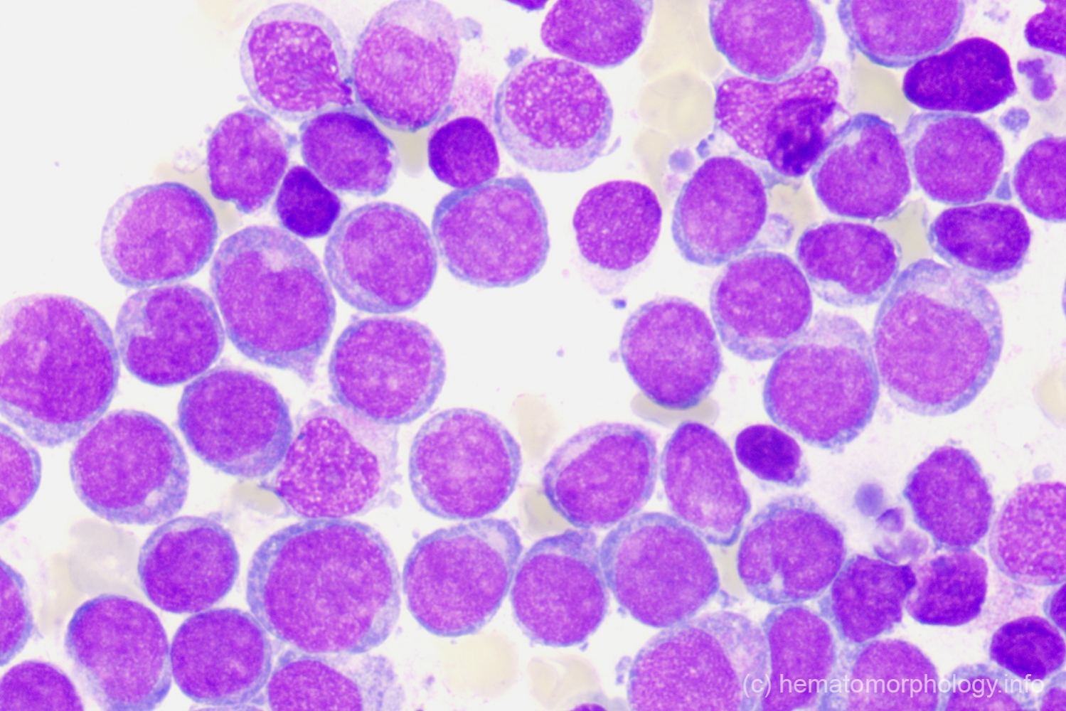 AML without maturation - Hematomorphology, a databank / imagebank for ...