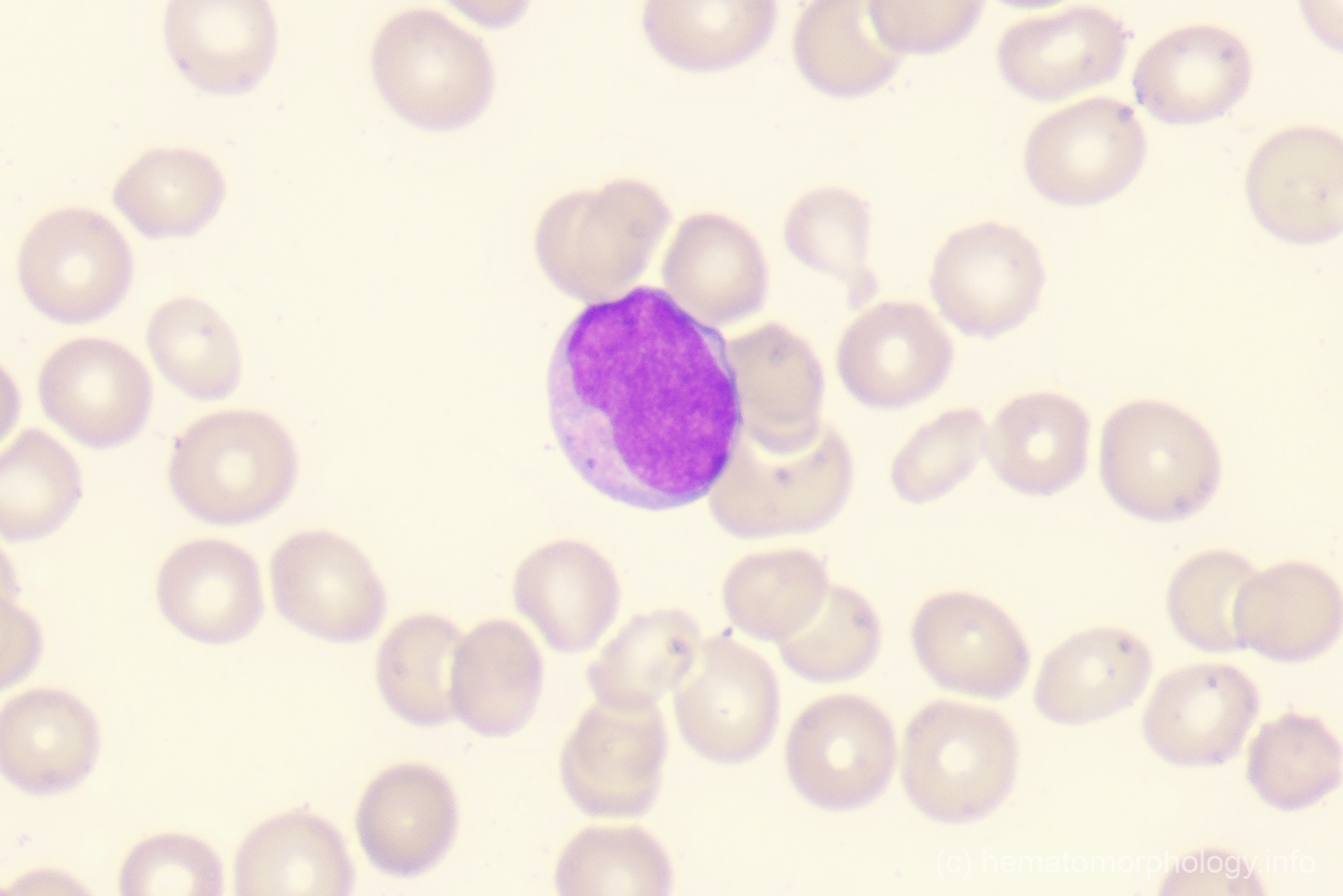 AML without maturation - Hematomorphology, a databank / imagebank for ...