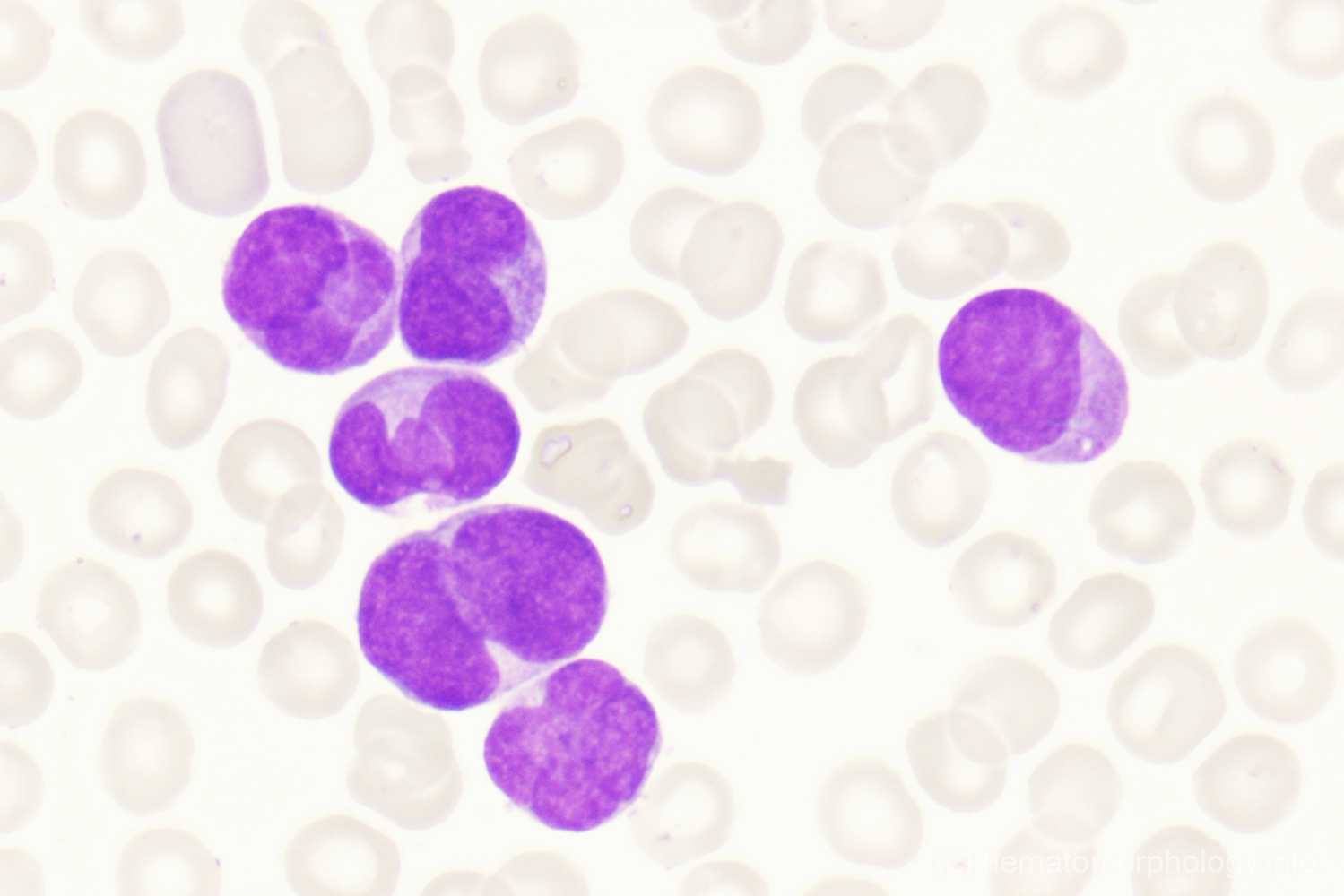 APL variant with PML-RARA - Hematomorphology, a databank / imagebank ...