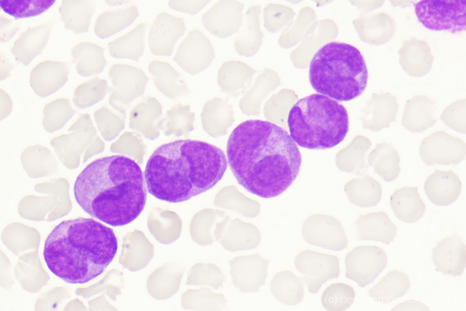 APL variant with PML-RARA - Hematomorphology, a databank / imagebank ...