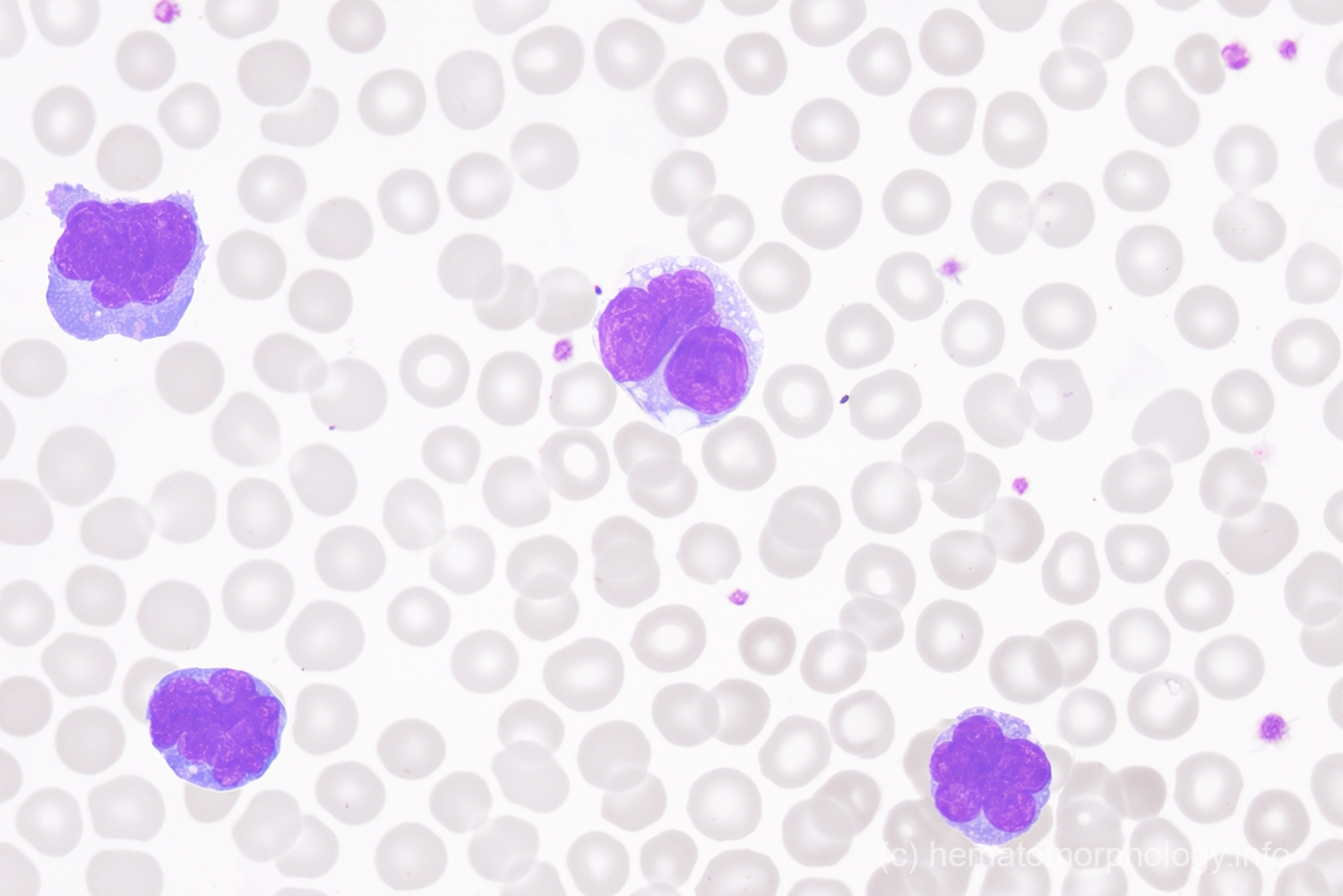 Adult T-cell Lymphoma/Leukemia (ATLL) - Hematomorphology, a databank ...
