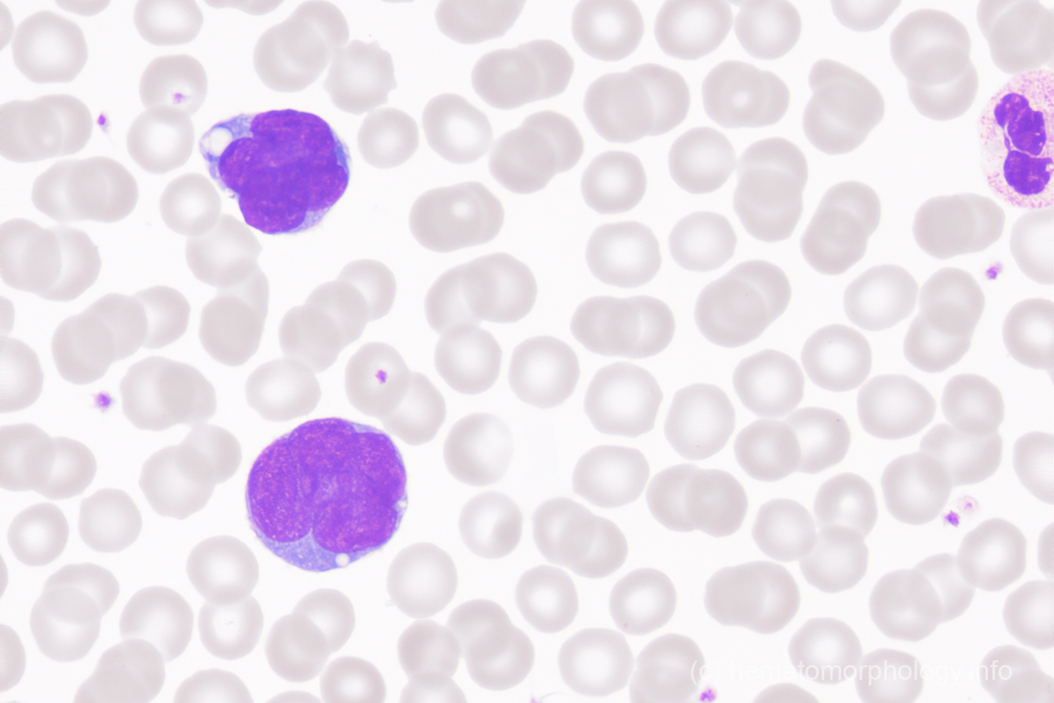 Adult T-cell Lymphoma/Leukemia (ATLL) - Hematomorphology, a databank ...