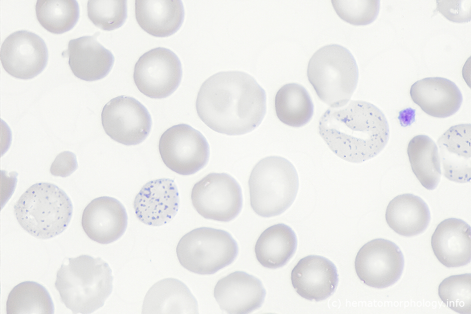Demo 1: basophilic stippling - Hematomorphology, a databank / imagebank ...