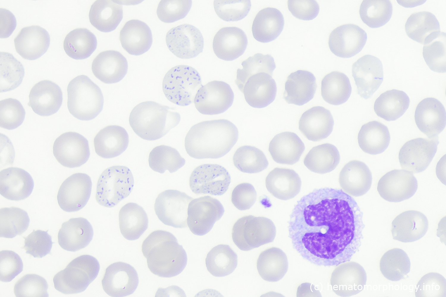 Basophilic stippling - Hematomorphology, a databank / imagebank for ...