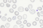 Demo 1: basophilic stippling - Hematomorphology, a databank / imagebank ...