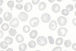 Demo 1: basophilic stippling - Hematomorphology, a databank / imagebank ...