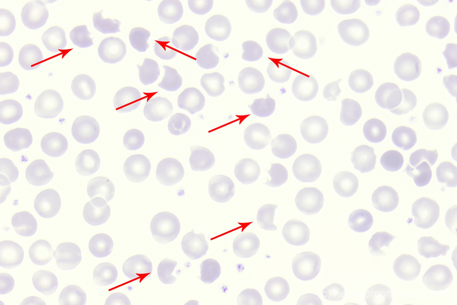 Bite cells - Hematomorphology, a databank / imagebank for hematology ...