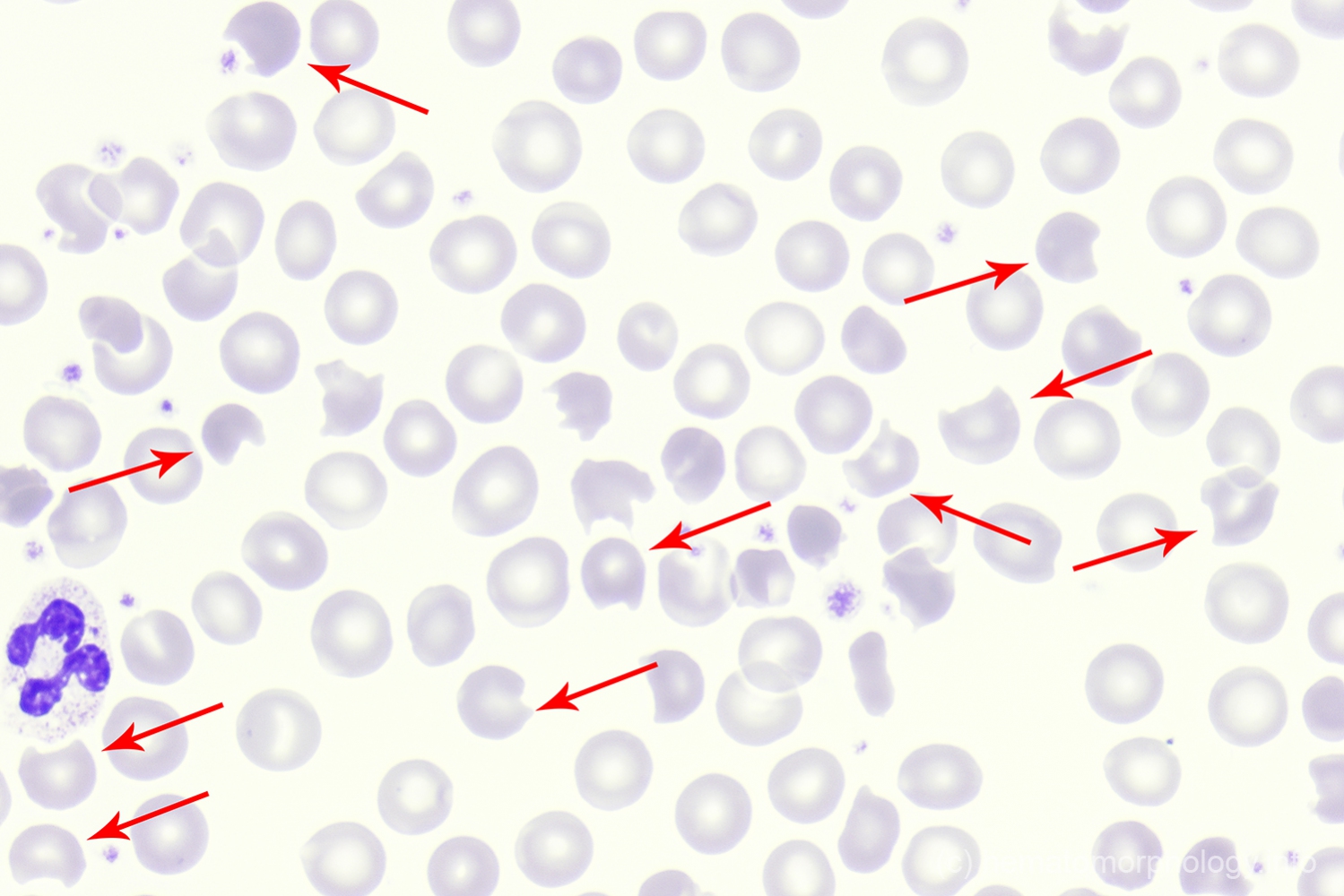 Bite cells - Hematomorphology, a databank / imagebank for hematology ...