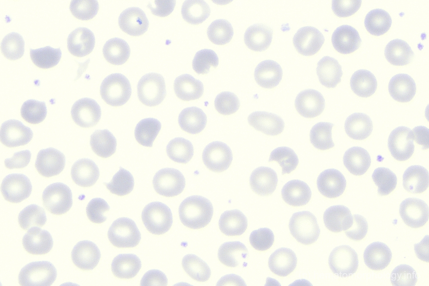 Bite cells - Hematomorphology, a databank / imagebank for hematology ...