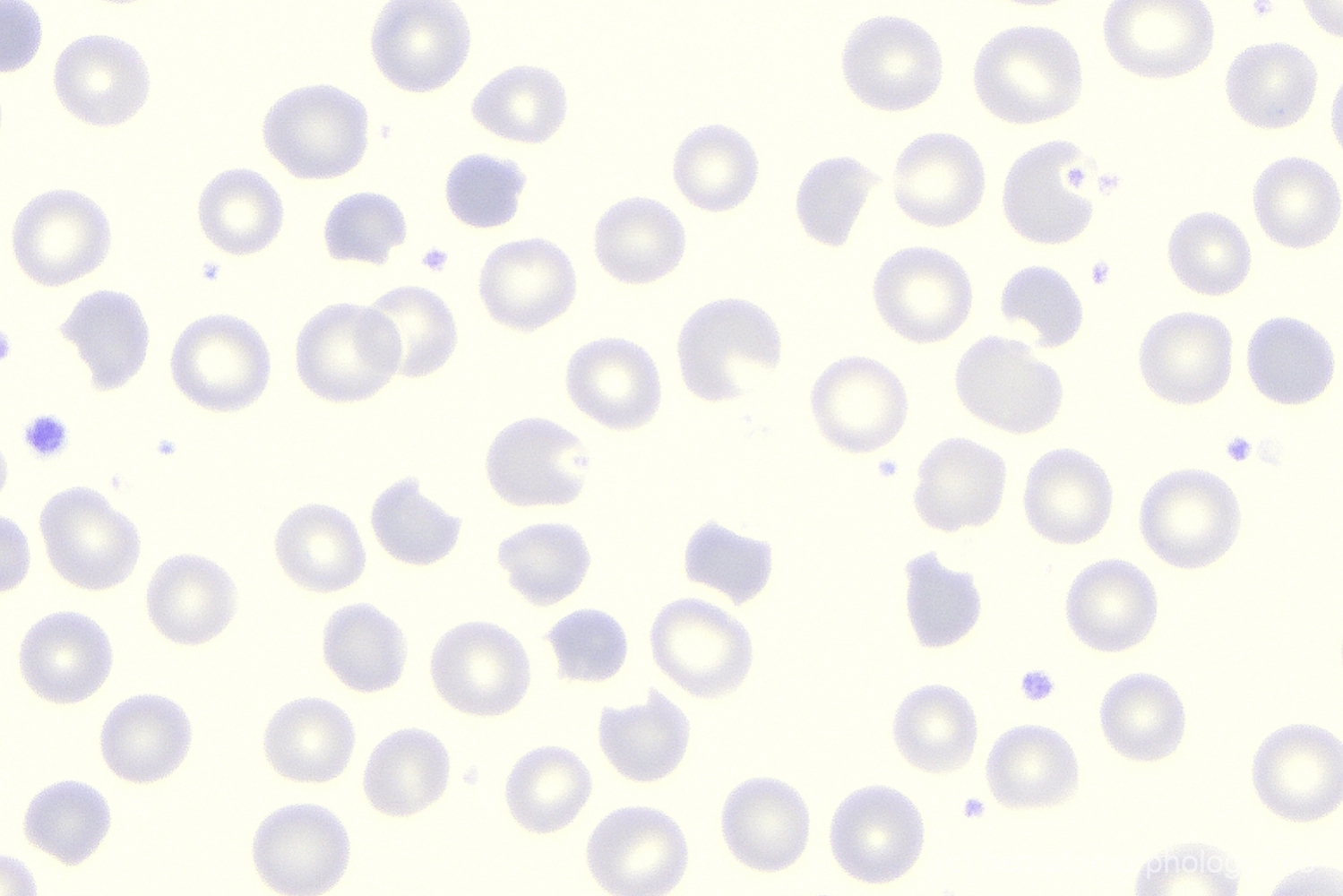 Bite cells - Hematomorphology, a databank / imagebank for hematology ...