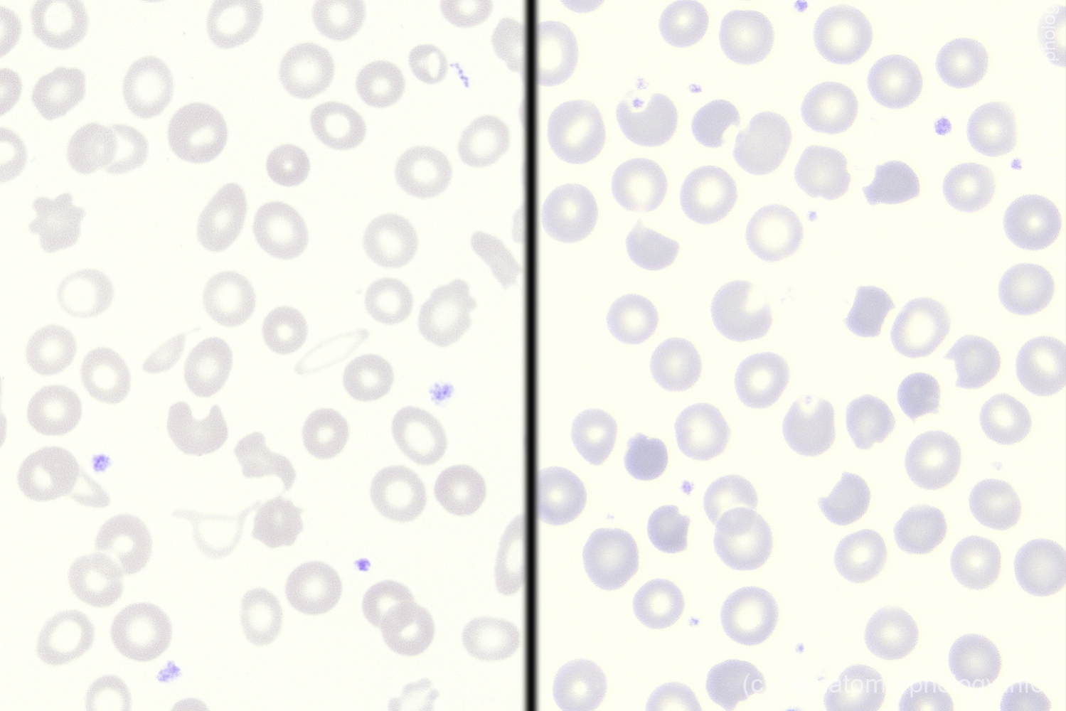 Bite cells - Hematomorphology, a databank / imagebank for hematology ...