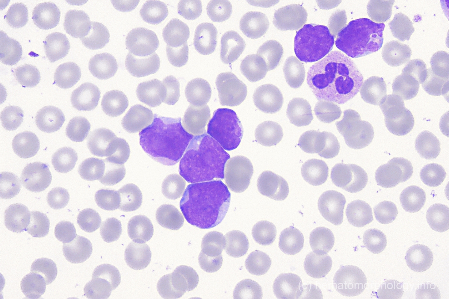 Blasts - Hematomorphology, a databank / imagebank for hematology, blood ...