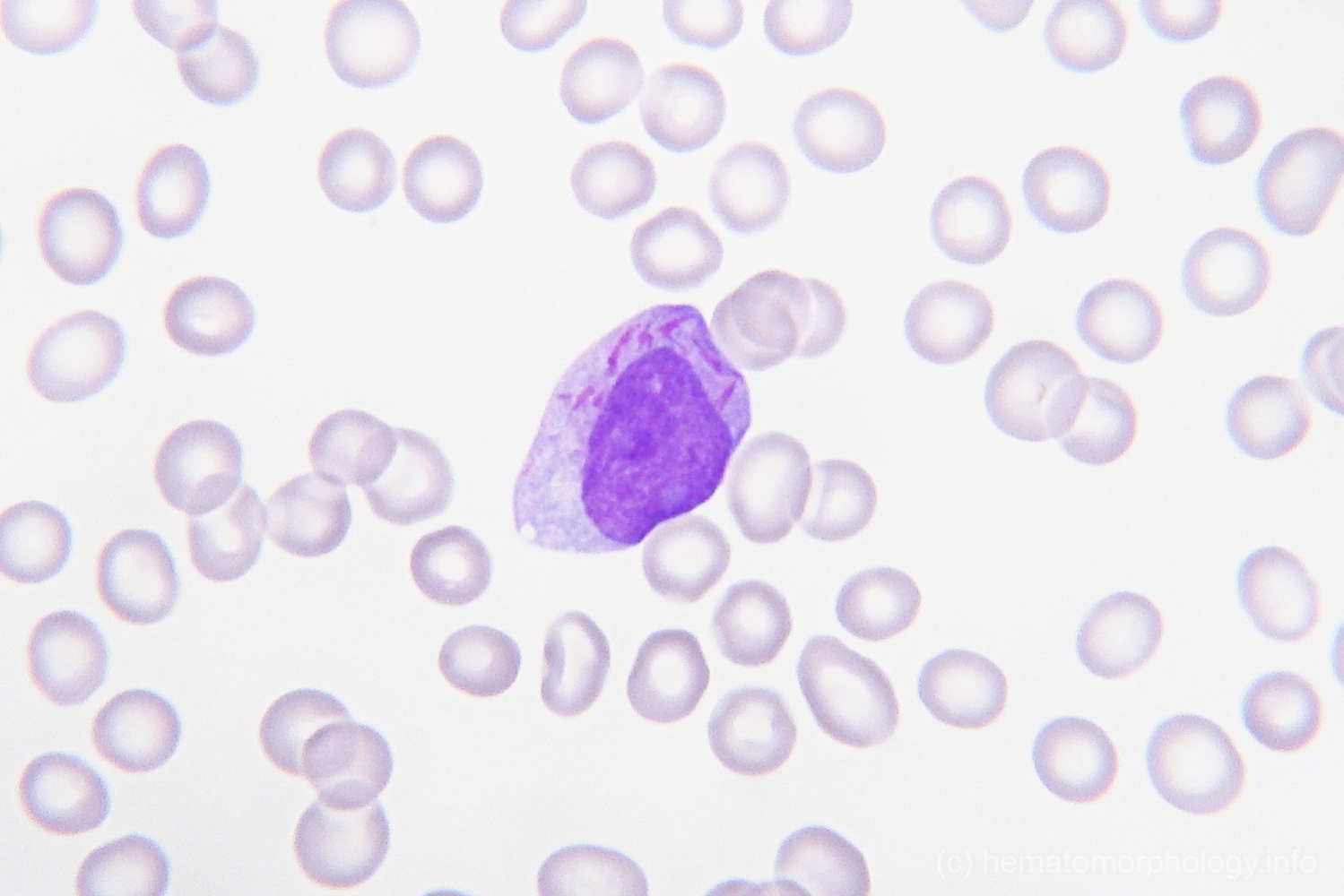 Blasts - Hematomorphology, a databank / imagebank for hematology, blood ...