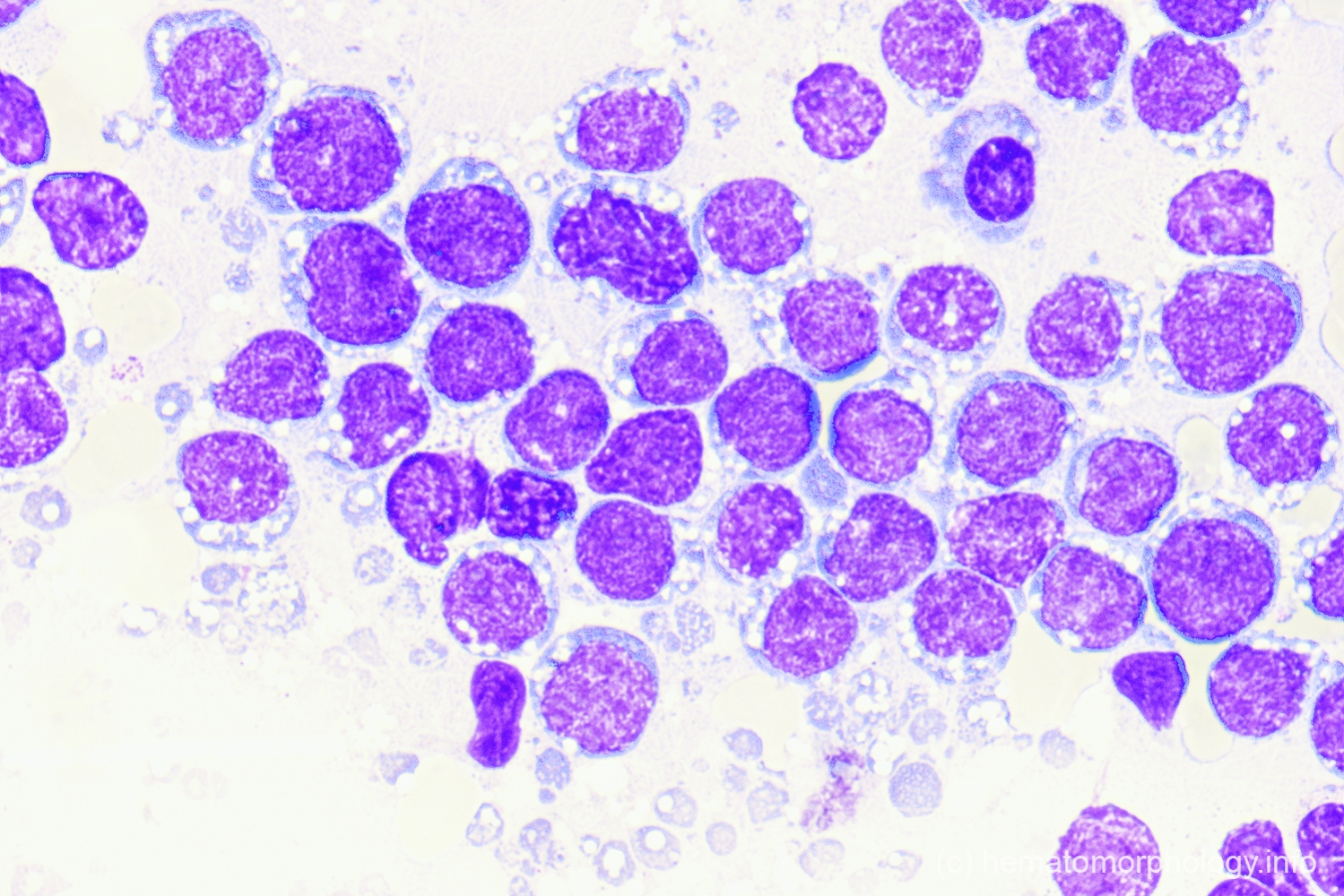 Burkitt Lymphoma - Hematomorphology, a databank / imagebank for ...