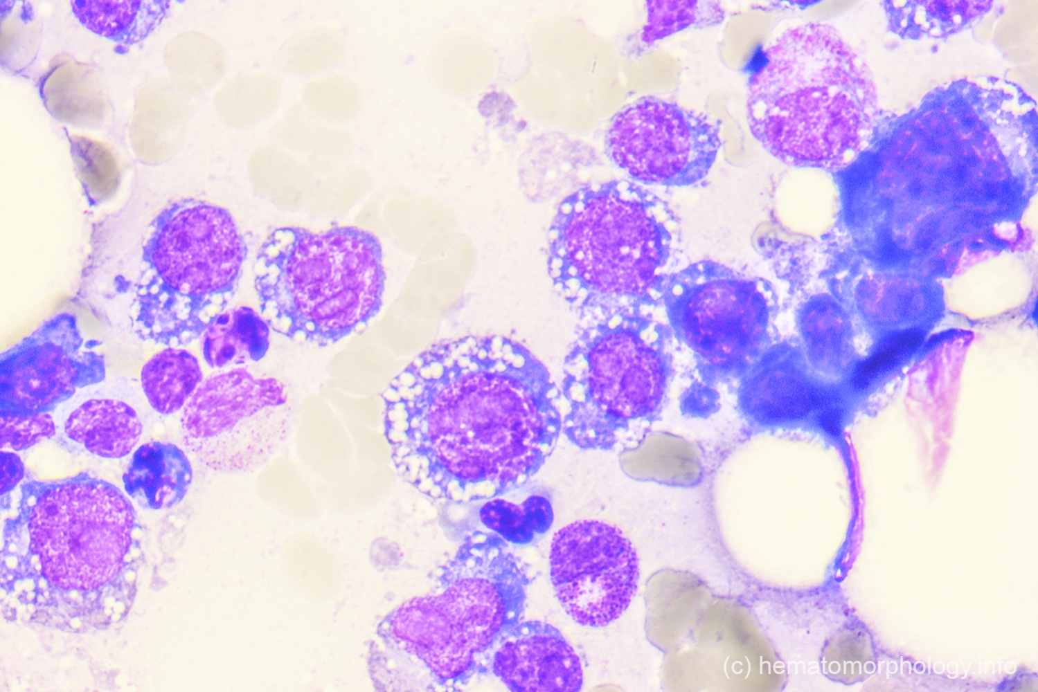 Burkitt Lymphoma - Hematomorphology, a databank / imagebank for ...