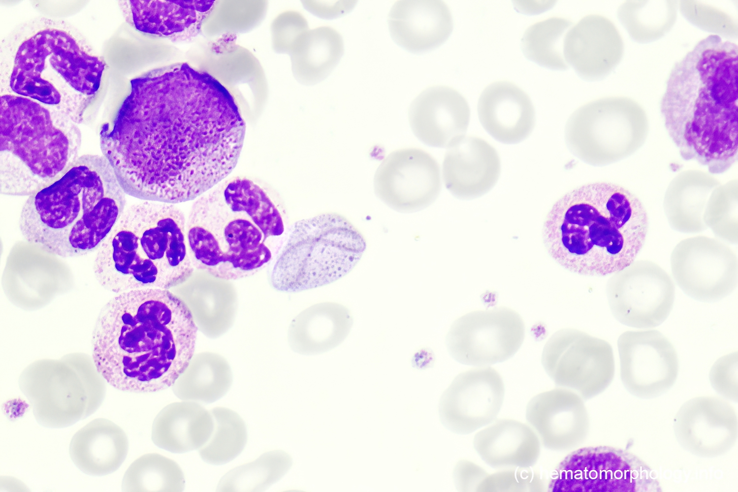 Cabot rings - Hematomorphology, a databank / imagebank for hematology ...