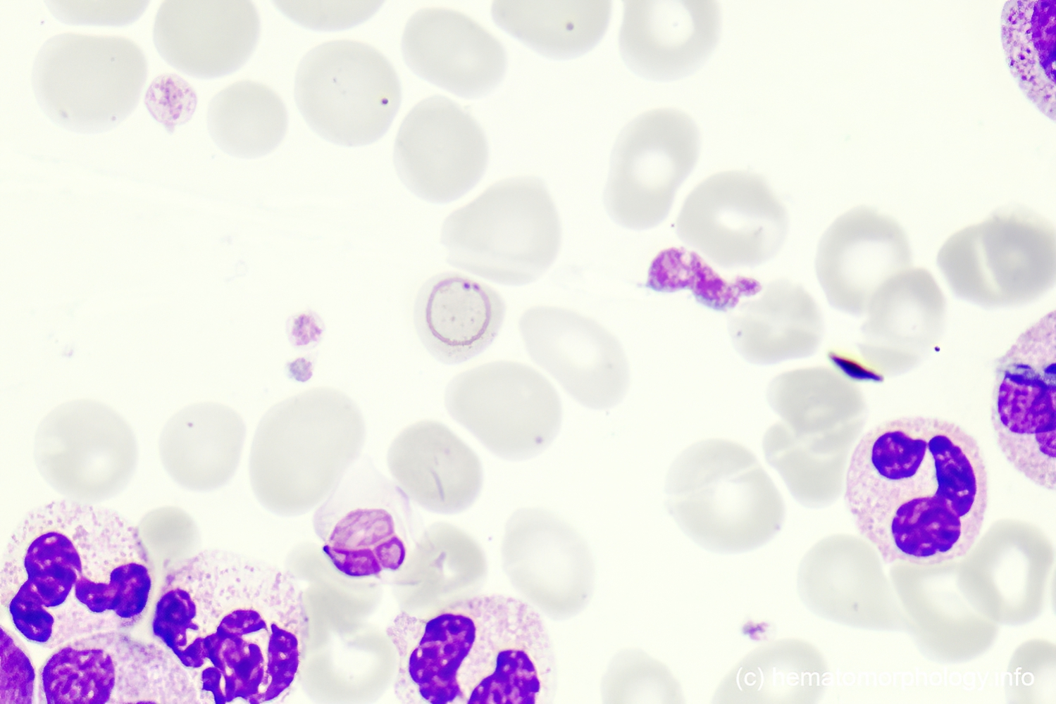 Cabot rings - Hematomorphology, a databank / imagebank for hematology ...