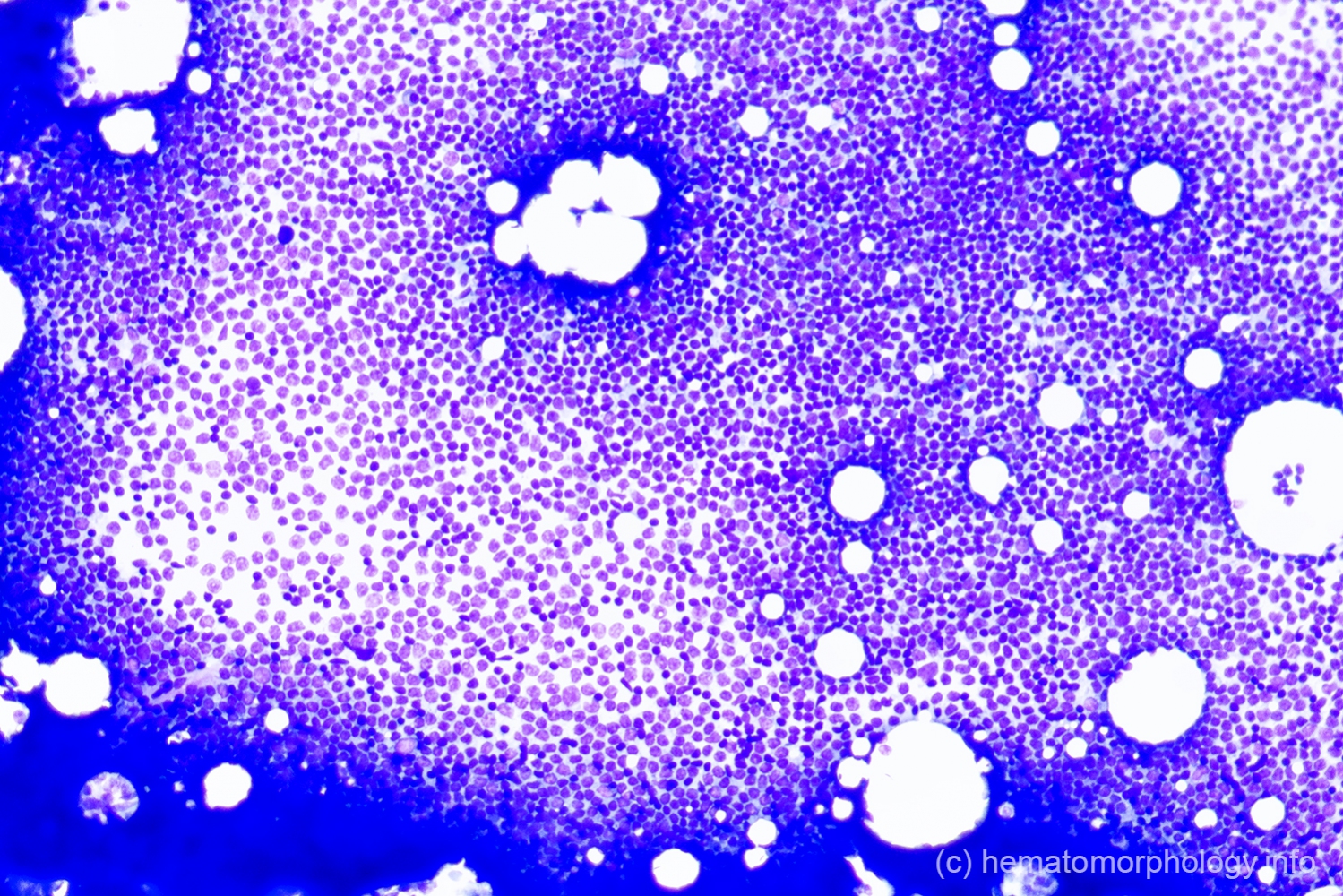 Chronic Lymphocytic Leukemia (CLL) - Hematomorphology, a databank ...