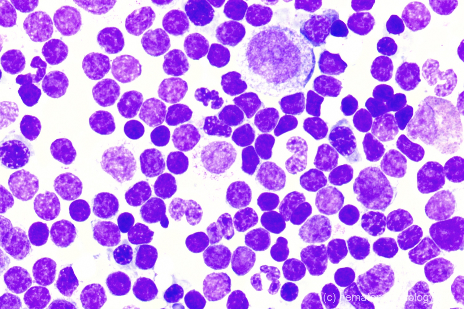 Chronic Lymphocytic Leukemia (CLL) - Hematomorphology, a databank ...