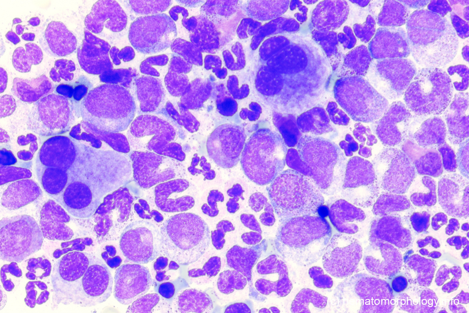 Chronic Myeloid Leukemia (CML) BCR-ABL 1+ - Hematomorphology, a ...