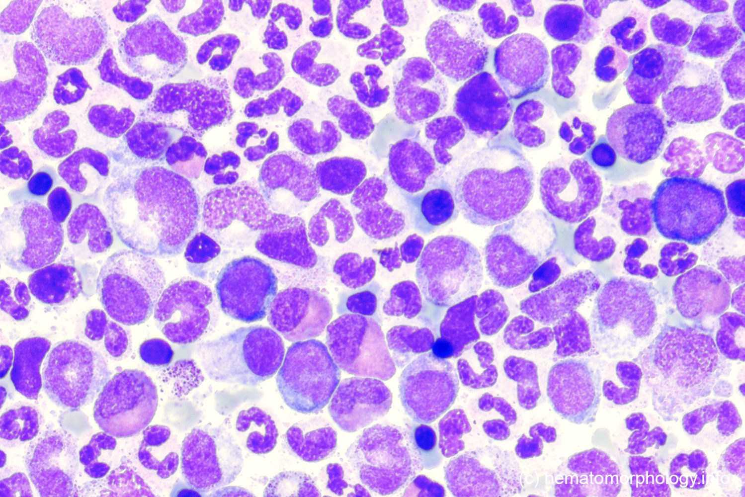 Chronic Myeloid Leukemia (CML) BCR-ABL 1+ - Hematomorphology, a ...