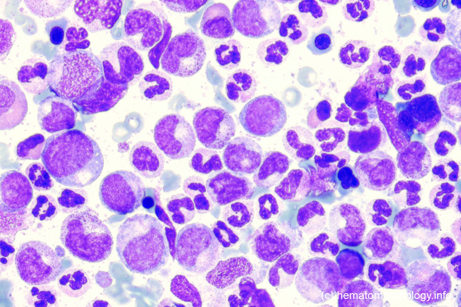 Chronic Myeloid Leukemia (CML) BCR-ABL 1+ - Hematomorphology, a ...