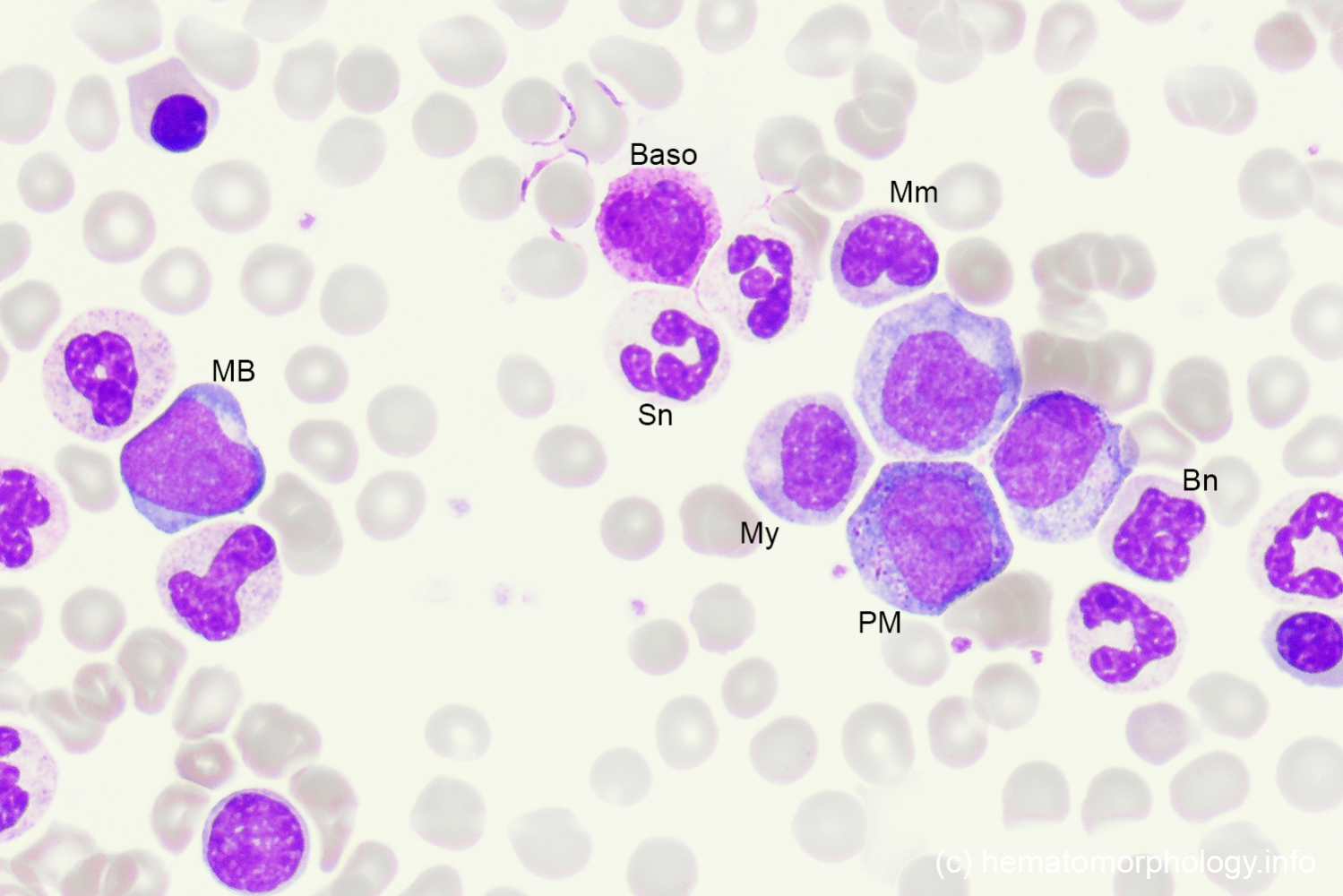 Chronic Myeloid Leukemia (CML) BCR-ABL 1+ - Hematomorphology, a ...