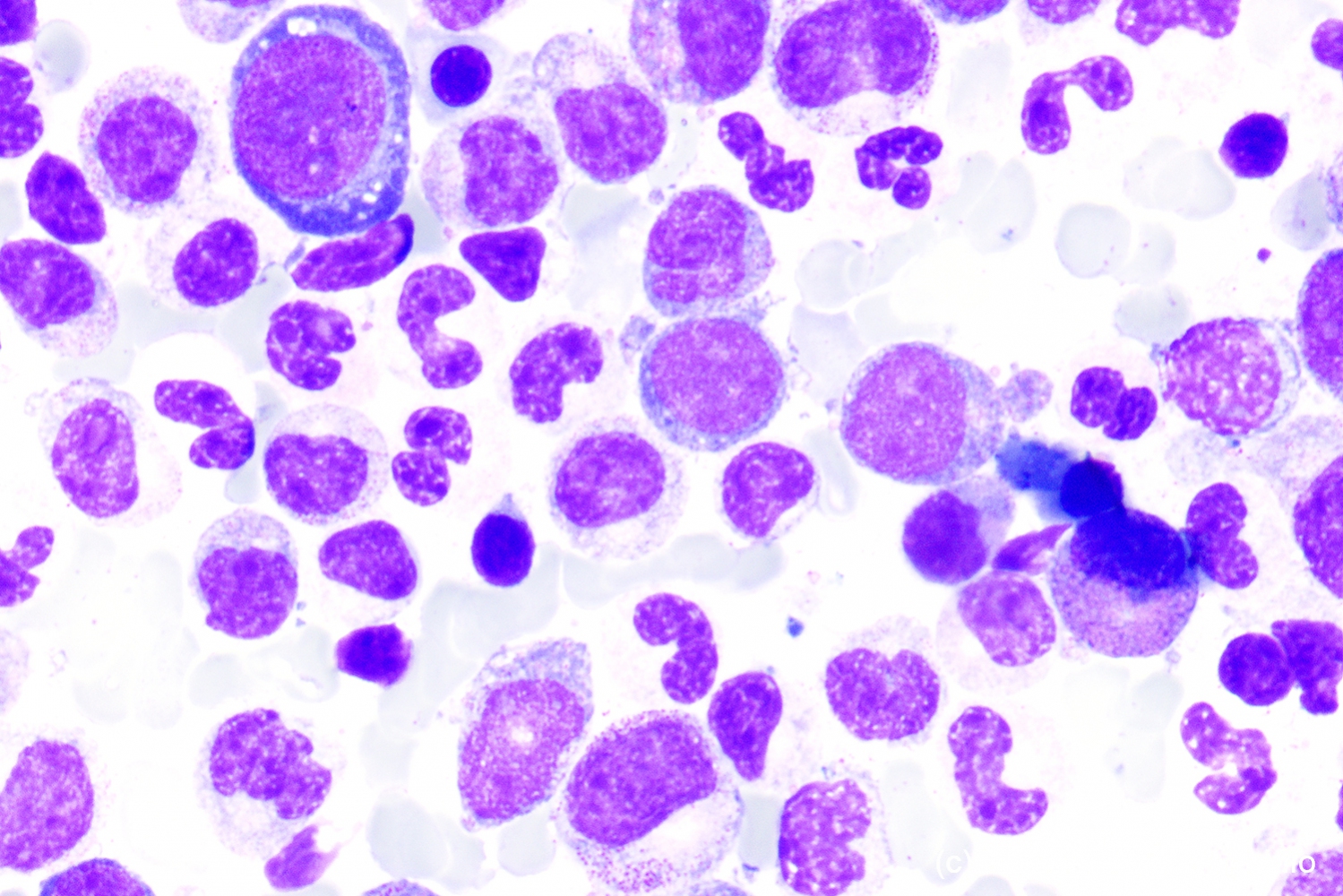 How Is Myelomonocytic Leukemia (Cmml) Treated? – LOAG