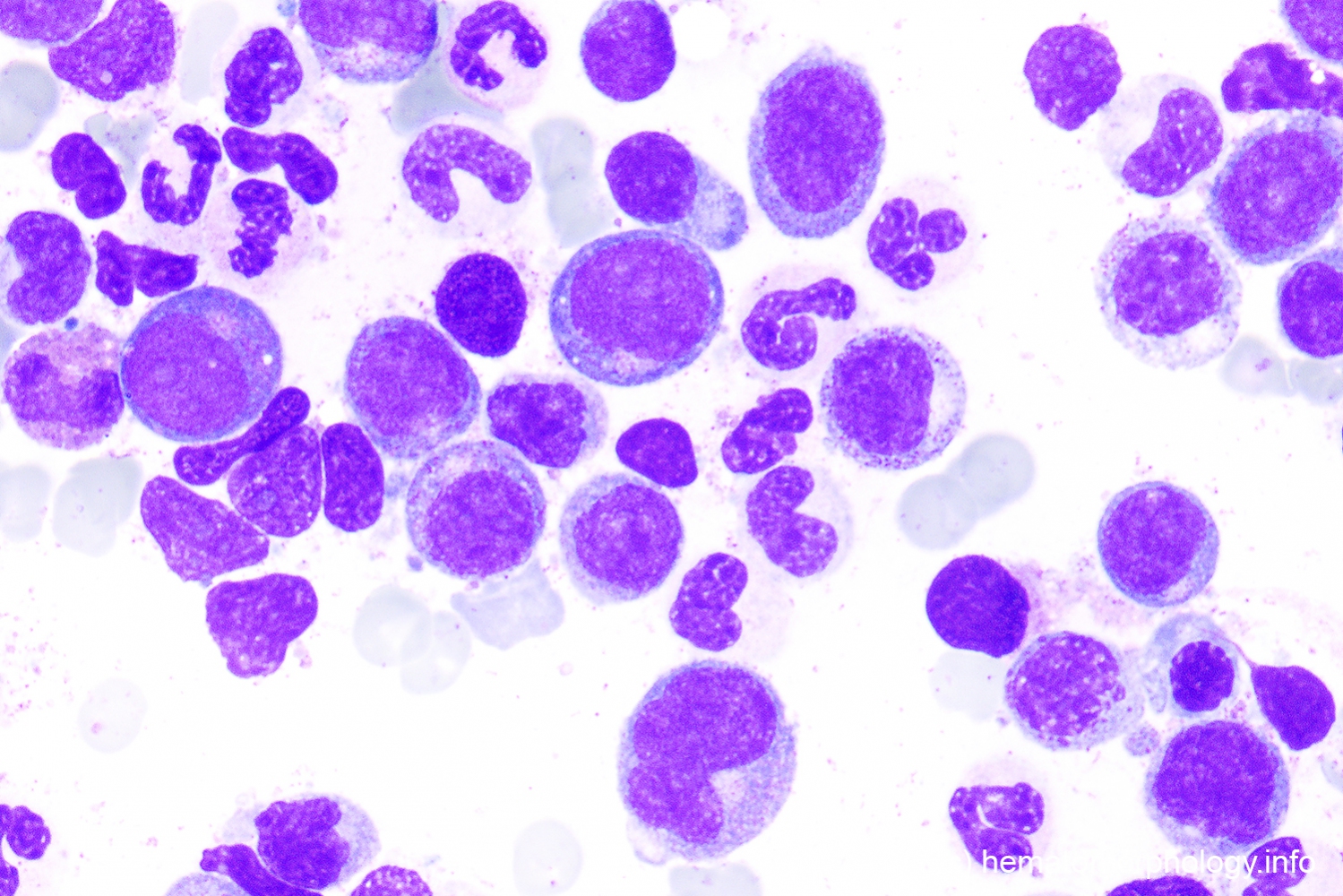 Chronic Myelomonocytic Leukemia (CMML) - Hematomorphology, a databank ...