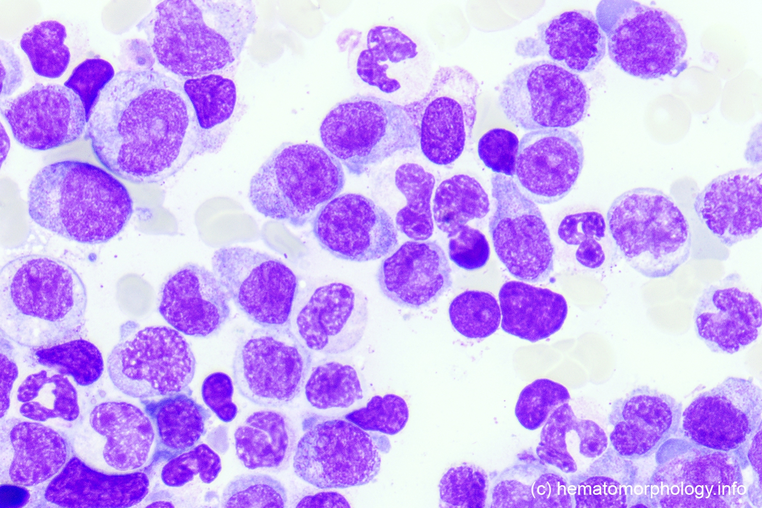 Chronic Myelomonocytic Leukemia (CMML) - Hematomorphology, a databank ...