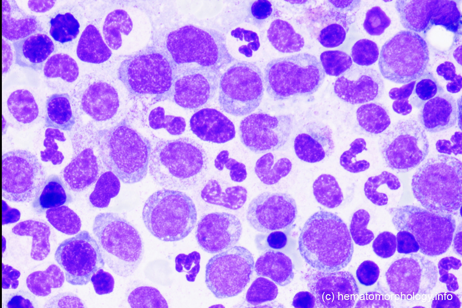 Chronic Myelomonocytic Leukemia (CMML) - Hematomorphology, a databank ...