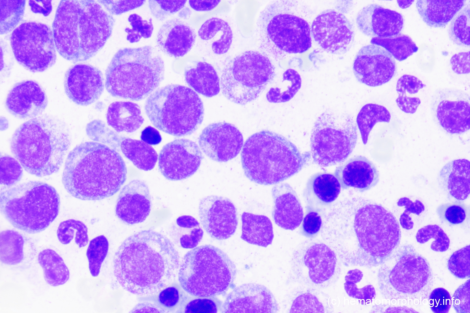 Chronic Myelomonocytic Leukemia (CMML) - Hematomorphology, a databank ...