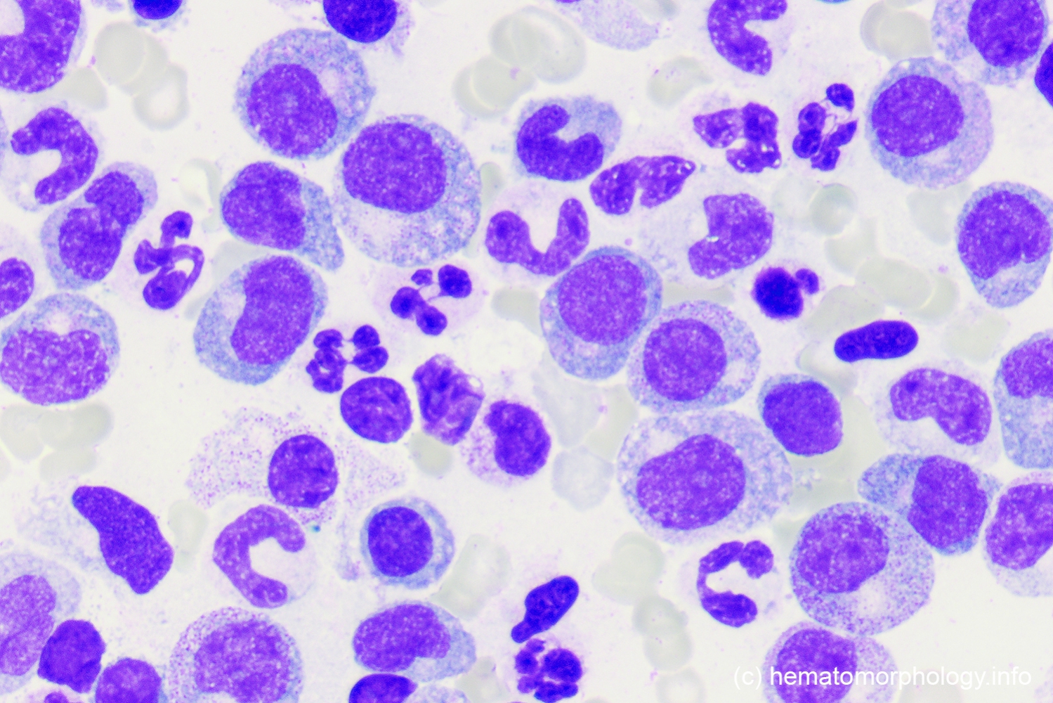 Chronic Myelomonocytic Leukemia (CMML) - Hematomorphology, a databank ...