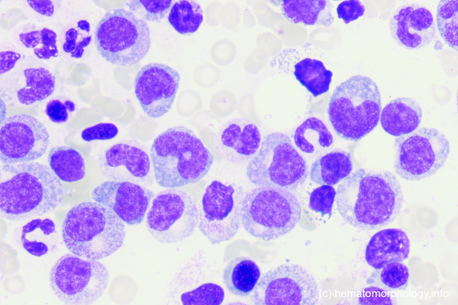 Chronic Myelomonocytic Leukemia (CMML) - Hematomorphology, a databank ...