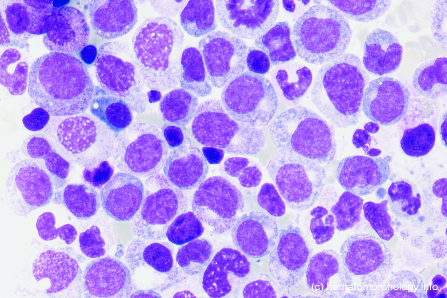 Chronic Myelomonocytic Leukemia (CMML) - Hematomorphology, a databank ...