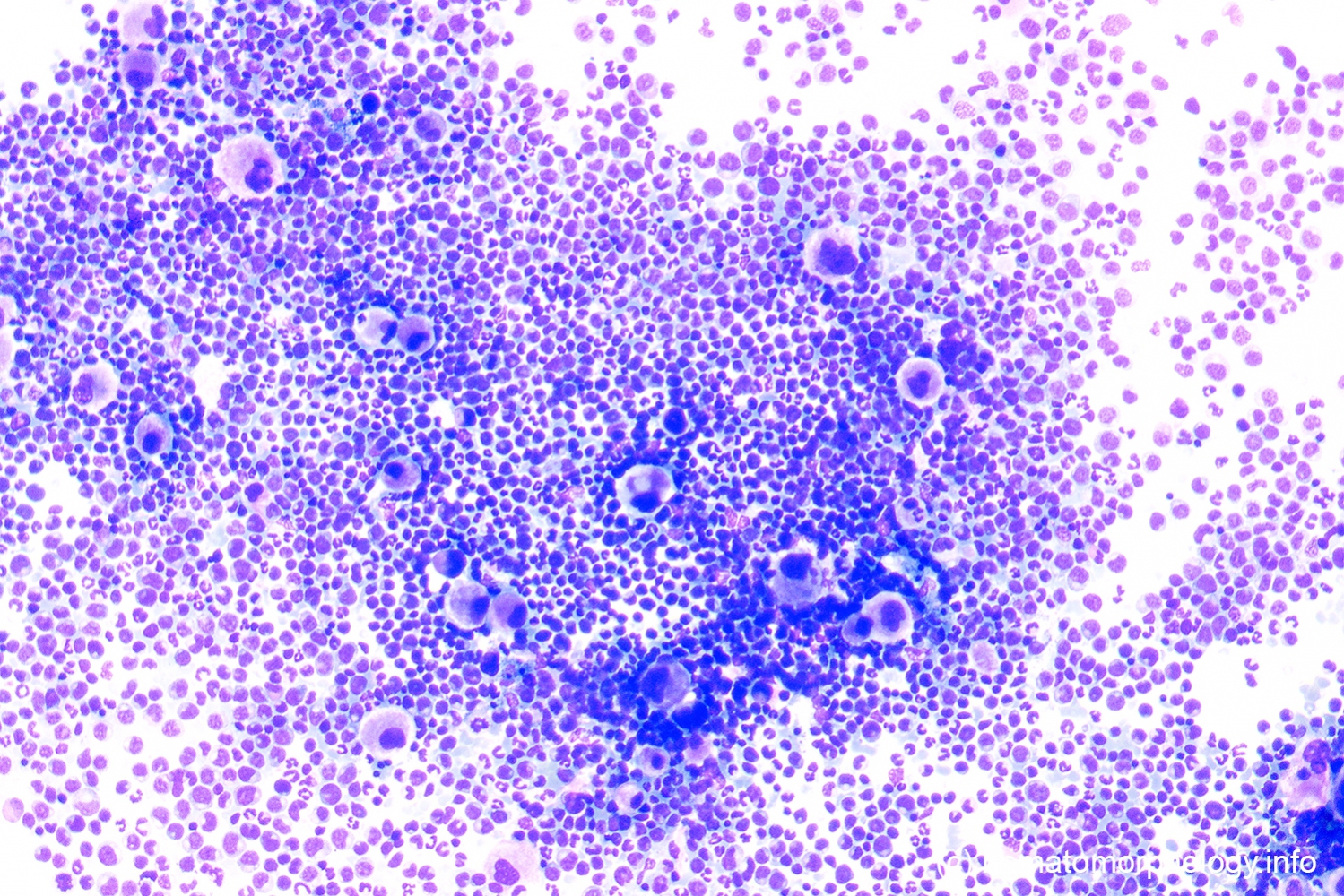 Chronic Myelomonocytic Leukemia (CMML) - Hematomorphology, a databank ...