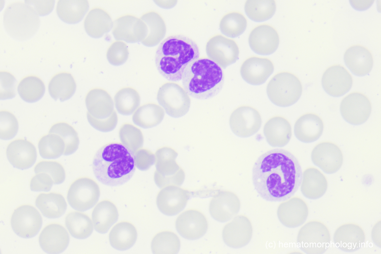 Chronic Myelomonocytic Leukemia (CMML) - Hematomorphology, a databank ...