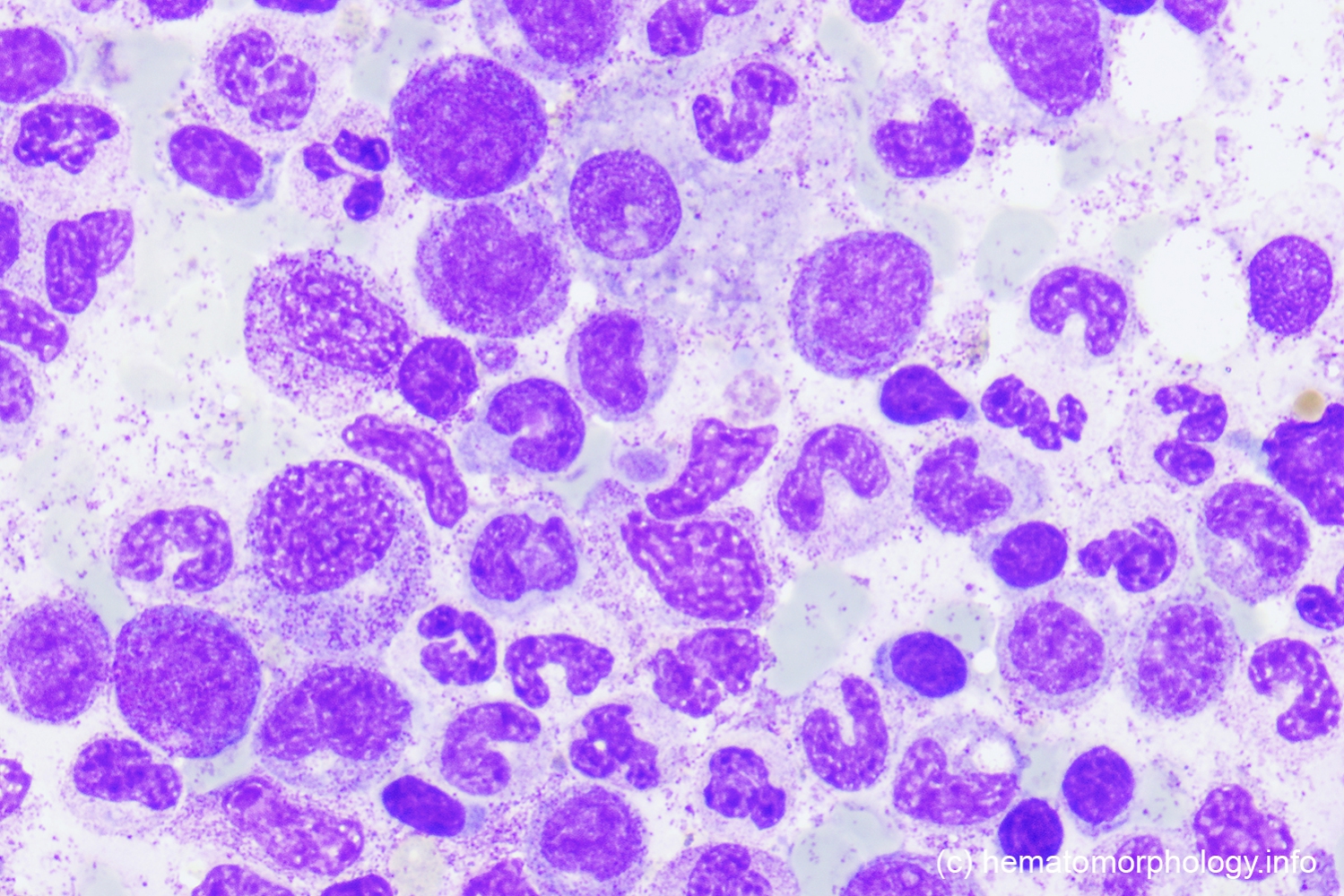 Neutrophilic Inflammation