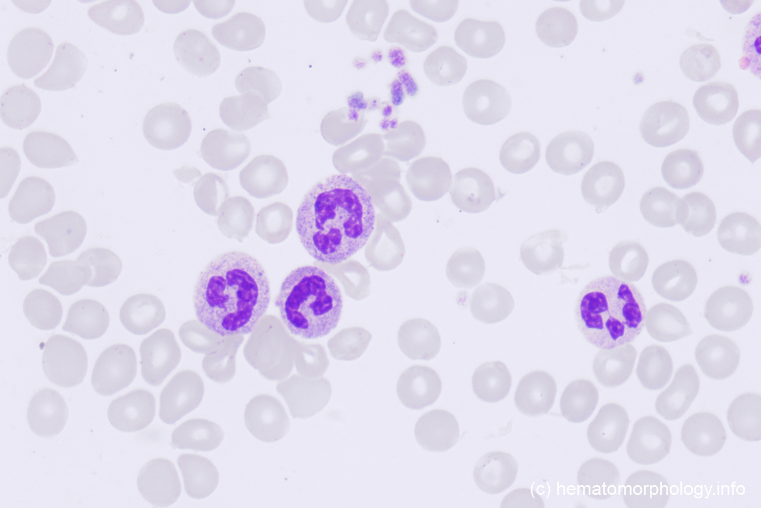 Chronic Neutrophilic Leukemia (CNL) - Hematomorphology, a databank ...