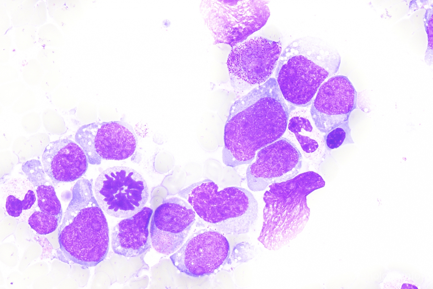 Diffuse Large B-cell Lymphoma (DLBCL) - Hematomorphology, a databank ...