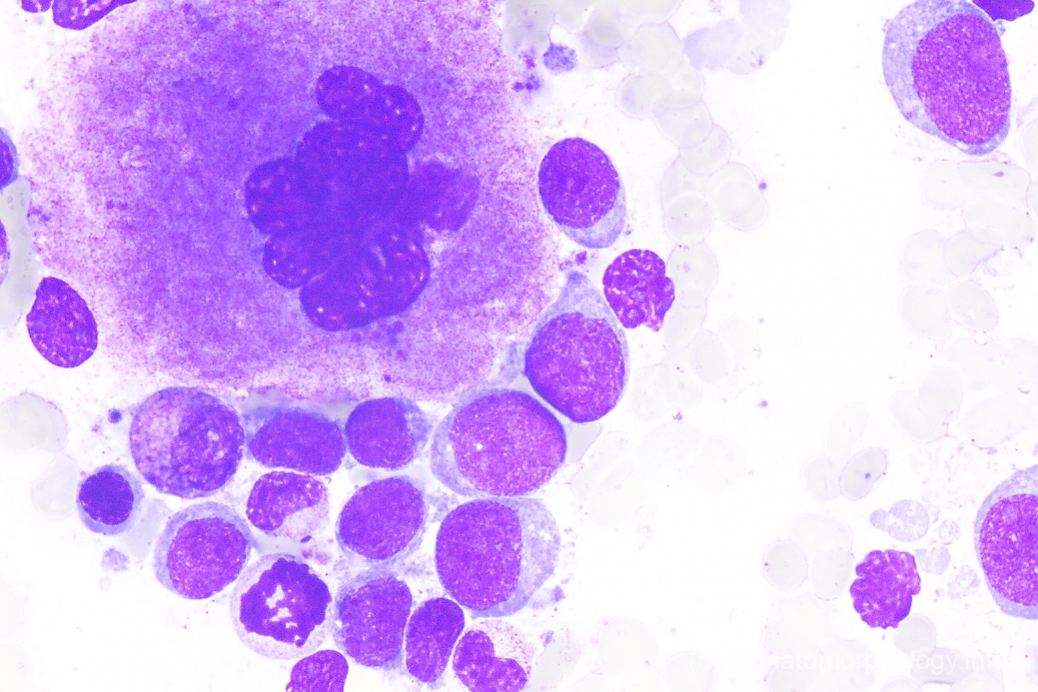 Diffuse Large B-cell Lymphoma (DLBCL) - Hematomorphology, a databank ...